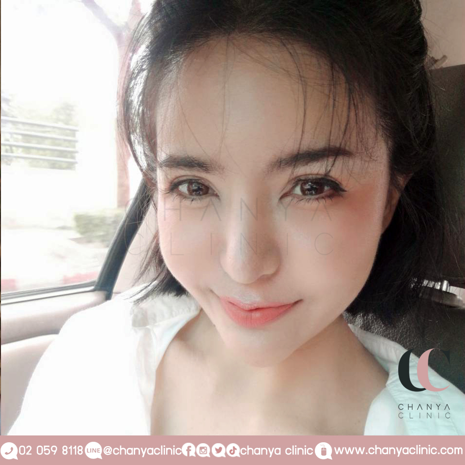 รวมรีวิวเคสเติมไขมันหน้าเด็ก ที่ Better Me Clinic