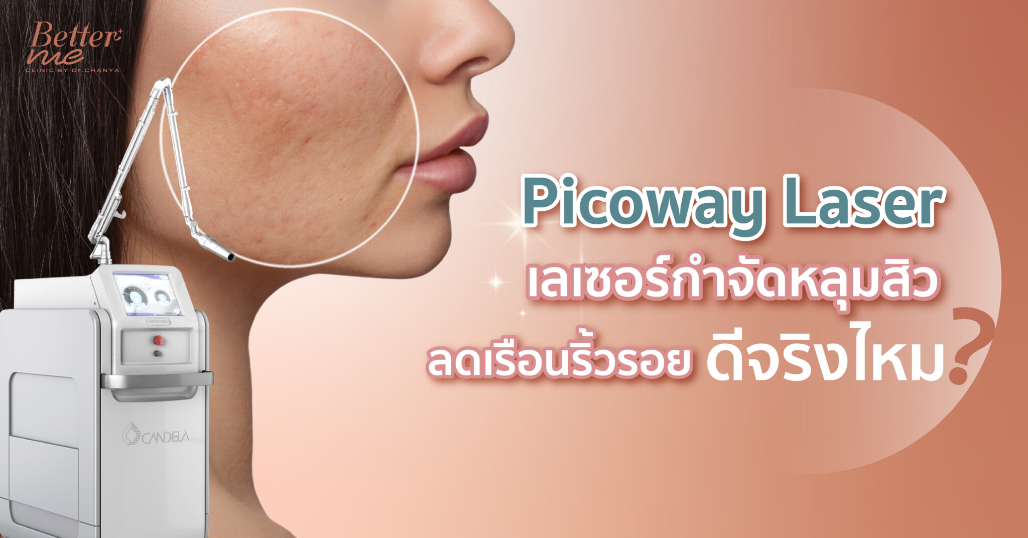 Picoway Laser เลเซอร์กำจัดหลุมสิว ช่วยลดเลือนริ้วรอย ดีจริงไหม ...