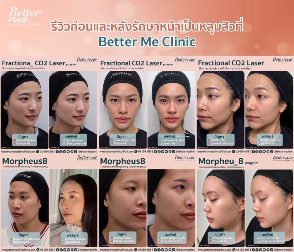 หน้าเป็นหลุมสิวเกิดจากอะไร? รักษาด้วยวิธีไหนดีถึงจะเห็นผล ปลอดภัย ...